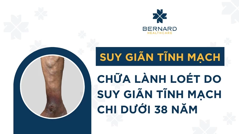 CHỮA LÀNH LOÉT DO SUY GIÃN TĨNH MẠCH CHI DƯỚI 38 NĂM